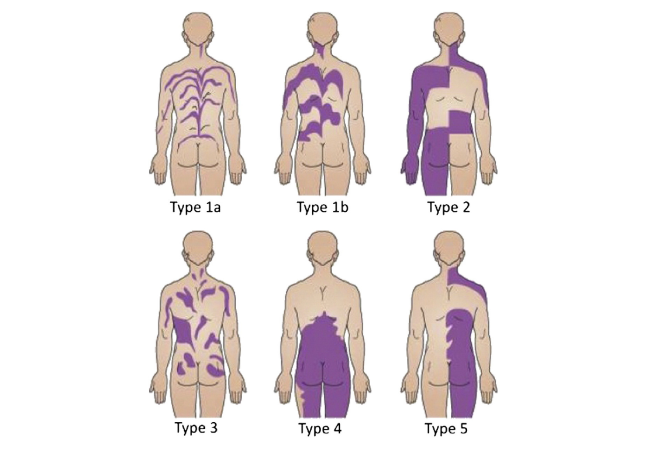 Humans Have Secret Stripes: Hidden Skin Patterns Explained